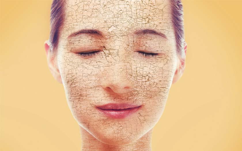 Why You Should Treat Xerosis Seriously. This Dry Skin Condition Is Not ...