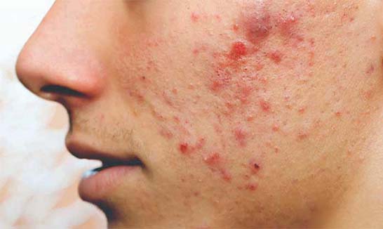 Help, It’s A Pimple! - NaturalHealth - Healthy, Beauty & Wellness Malaysia